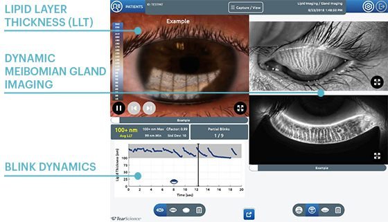 Lipi View II Ocular Surface Interferometer | Dauh Eye Care
