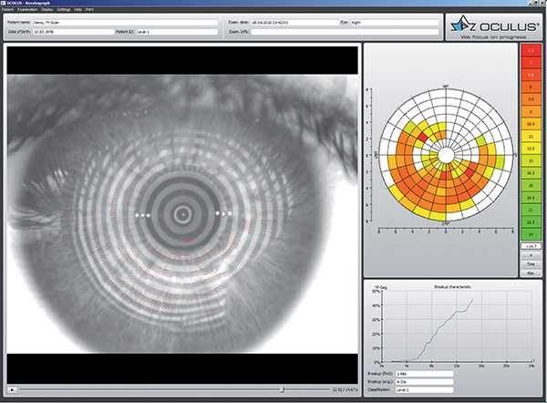 OCULUS Keratograph 5M Topographer | Dauh Eye Care