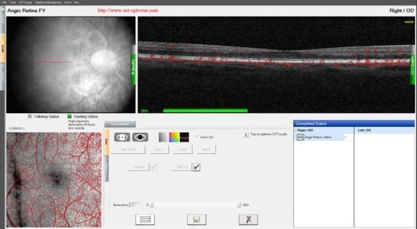 Optovue AngioVue OCT and OCTA Imaging System | Dauh Eye Care