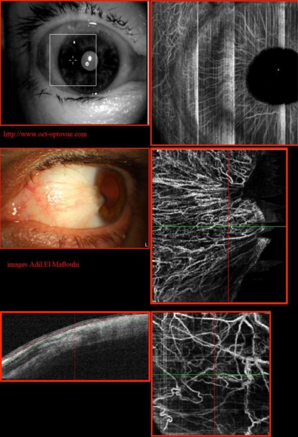 Optovue AngioVue OCT and OCTA Imaging System | Dauh Eye Care